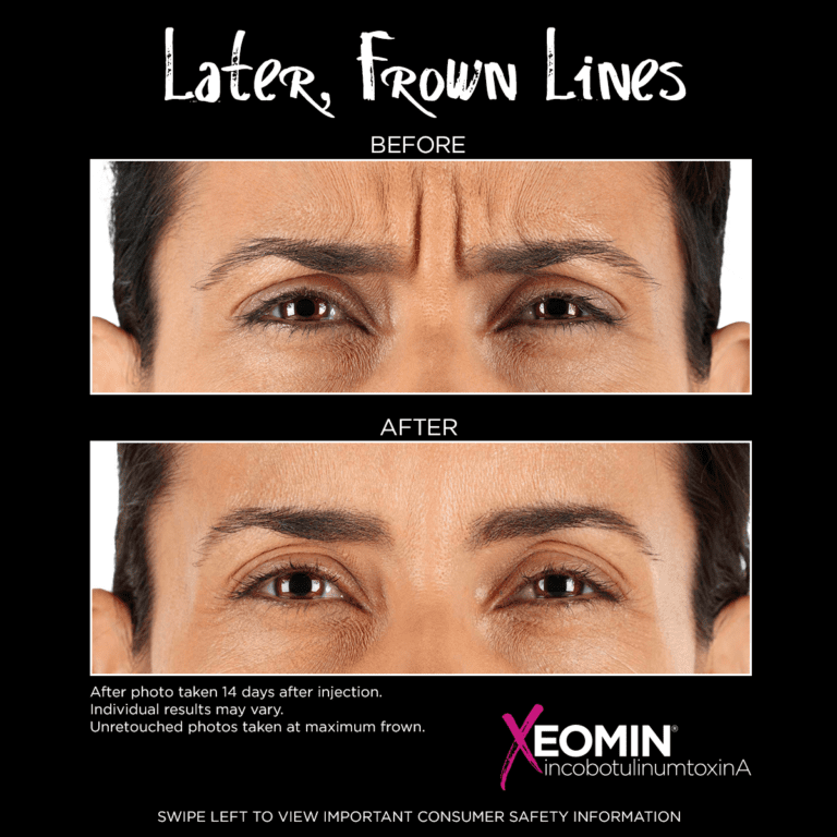 Xeomin Injections | Fayetteville, NC | Élan Med Spa